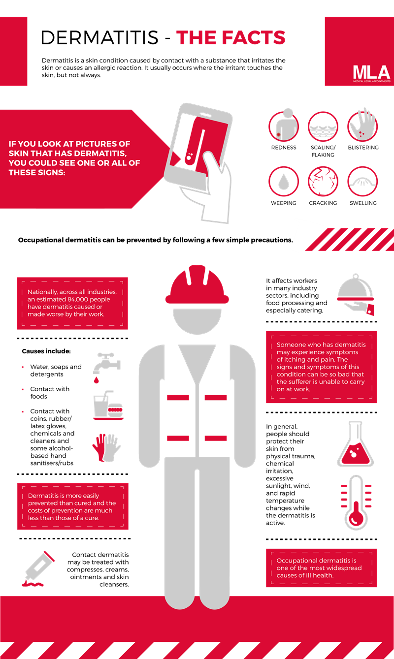 Occupational Dermatitis The Facts